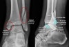 발목 골절fracture Of Ankle 발목이 비틀리면서 발목 뼈가 부러졌어요 네이버 블로그